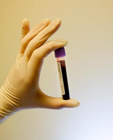 Lab Testing: What a CBC Can Tell Us About Osteoporosis - Great Bones